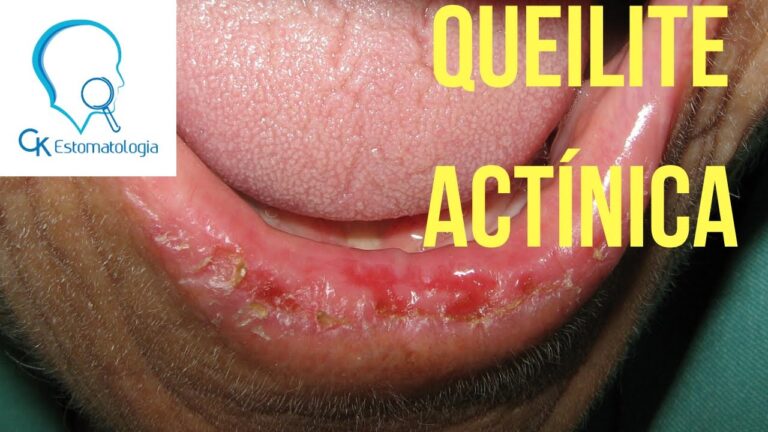 Labios inflamados: Causas, tratamentos e dicas para aliviar ...